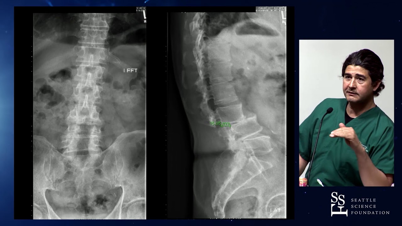 Tips & Tricks for the Lateral Approach - Rod J. Oskouian, Jr, MD - YouTube