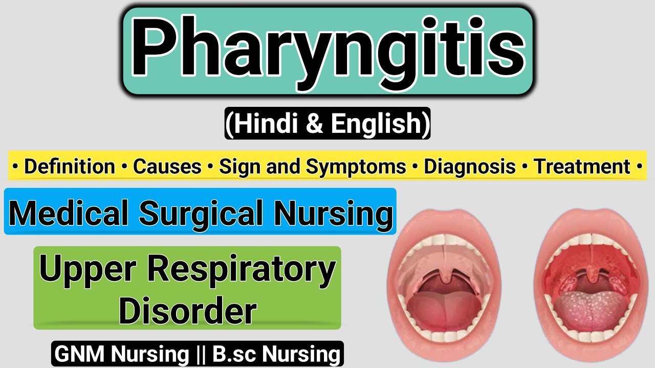Pharyngitis: Definition, Causes, Signs and symptoms, Diagnosis ...