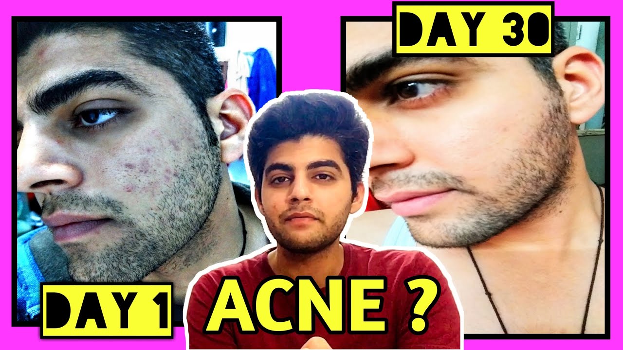 Best ACNE/Pimple Treatment | Cause & Pathology of Acne | Dr. Akshay ...