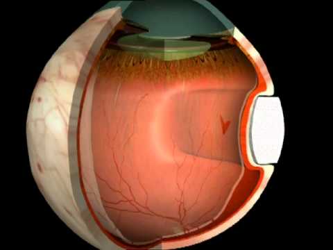 PROF.DR. KAAN ÜNLÜ - Retina Dekolmanı