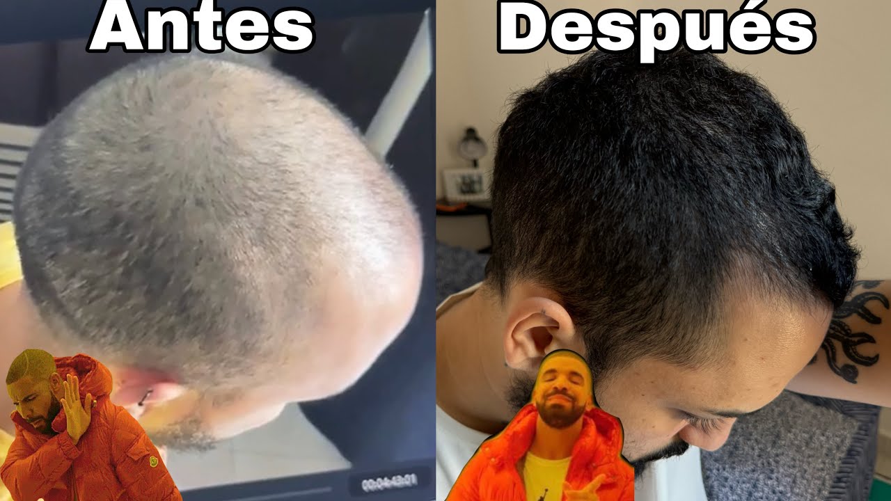 Dejé de ser CALVO con este producto! | ¡¡INCREÍBLE CAMBIO!! (NO ...