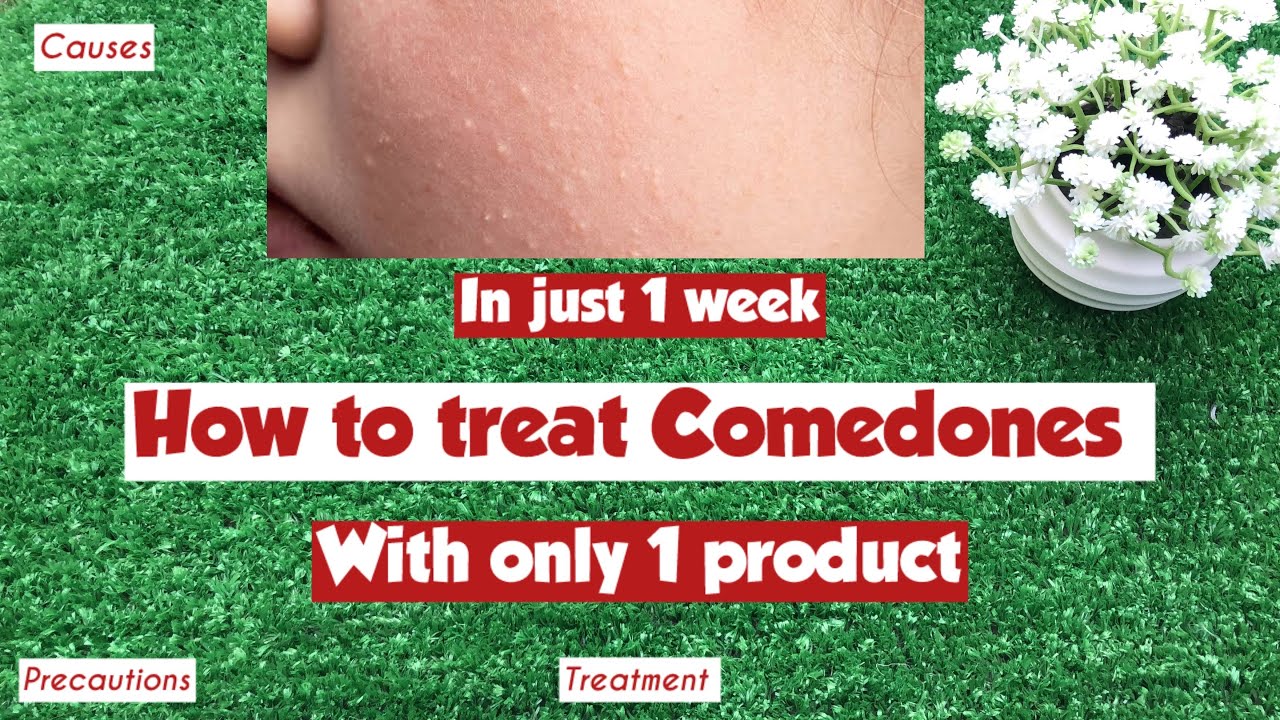 How to treat Closed Comedones in a Week ⁉️| Causes of Comedonal Acne ...