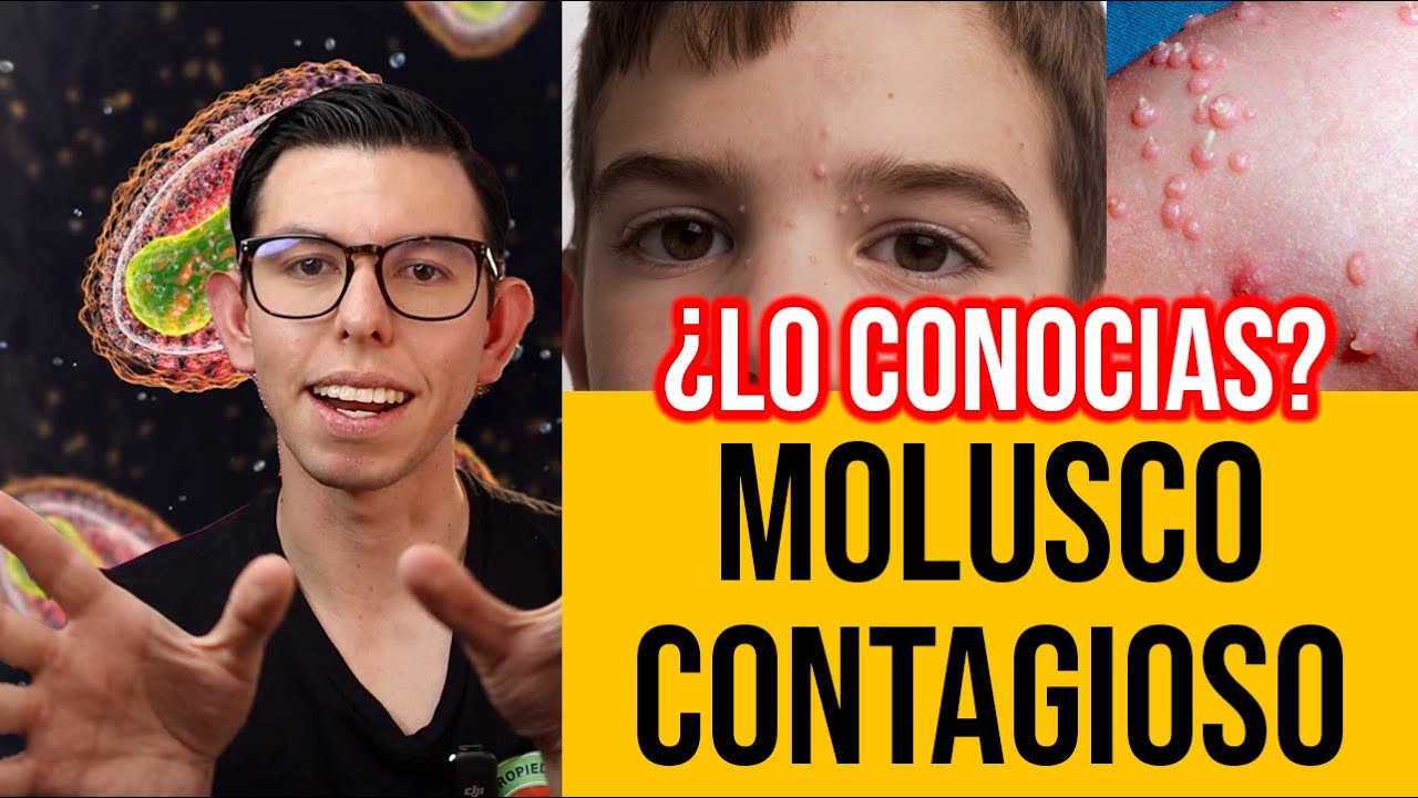 MOLUSCO QUE!! (Todo sobre MOLUSCO CONTAGIOSO) | DrPoloGuerrero - YouTube