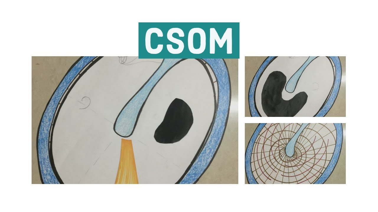 CSOM (Chronic suppurative otitis media) | The White Army - YouTube