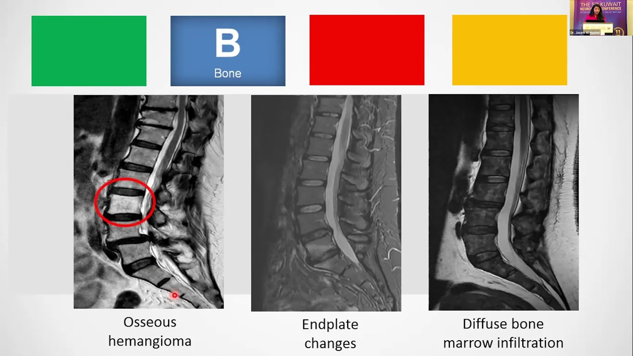 Interpreting MRI of the spine As simple as ABCD - YouTube