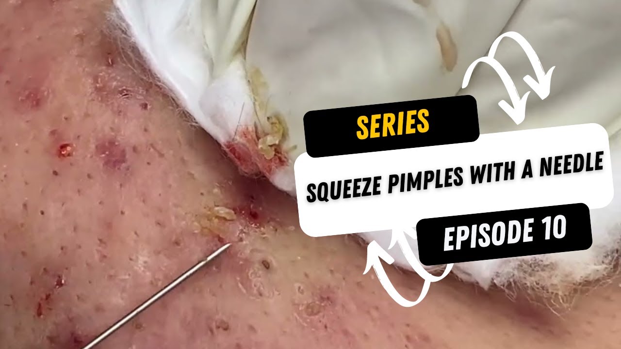 Squeeze Pimples With A Needle 10 - YouTube
