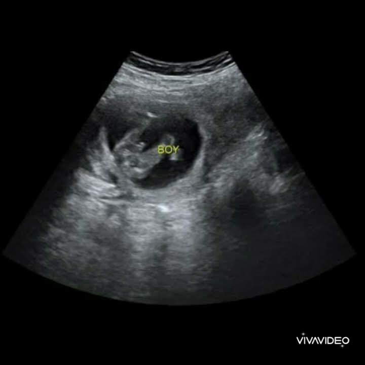 baby boy at 16 wk on ultrasound (turtle sign)#male gender - YouTube