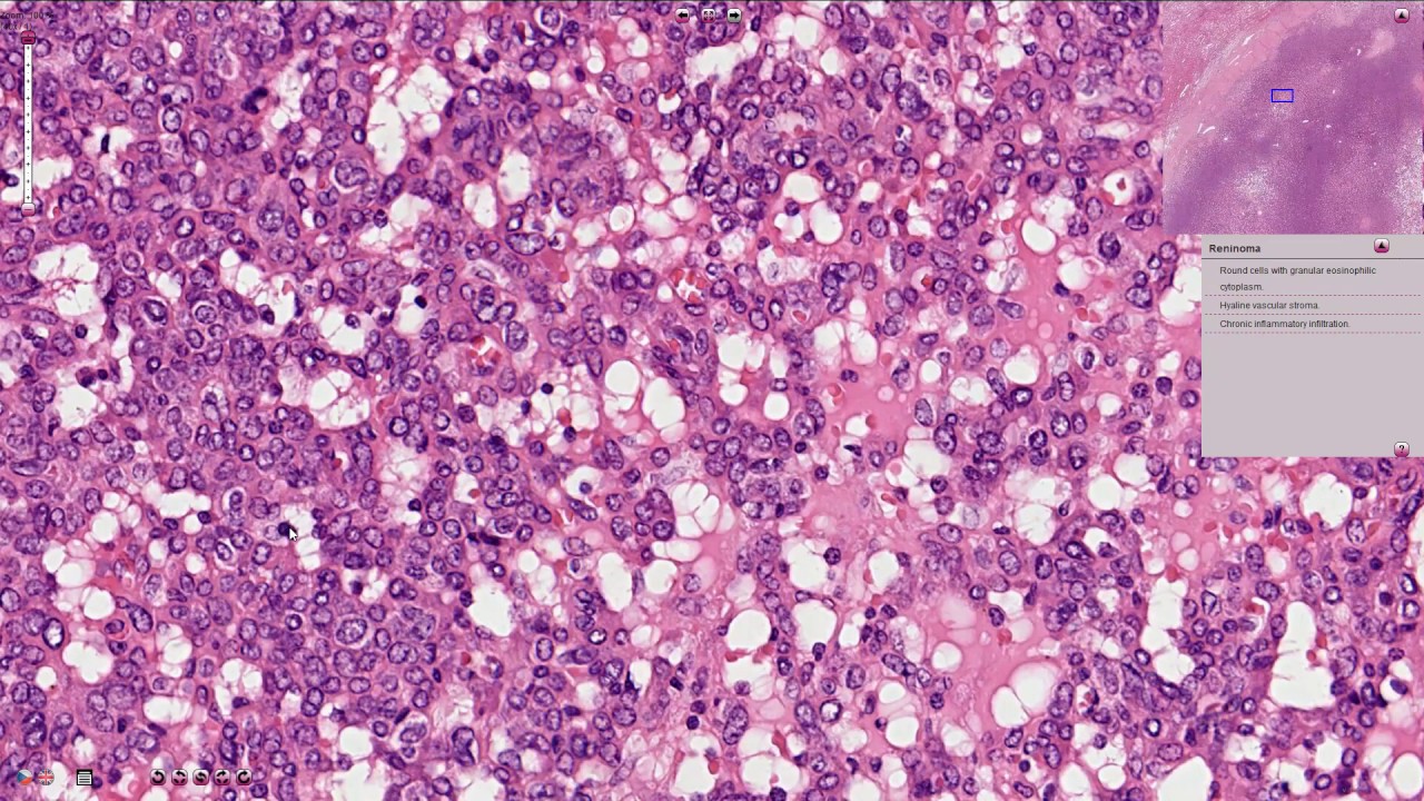 Reninoma / Juxtaglomerular Cell Tumor - Kidney, Histopathology - YouTube