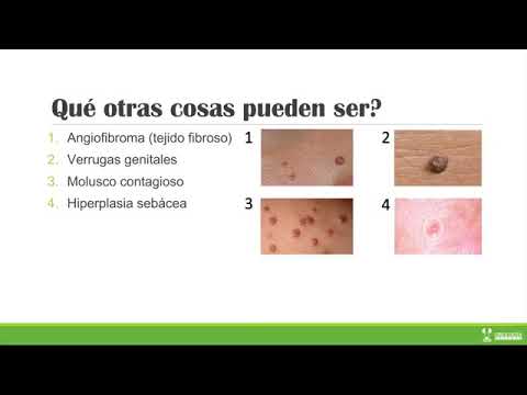 Qué son las pápulas perladas? - YouTube