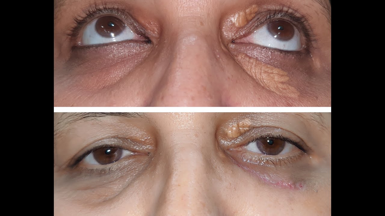 Bloodless Excision of Giant xanthelasma Lower eyelid - YouTube