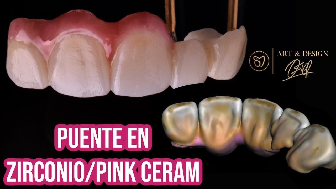 DISEÑO DE PUENTE/ENCIA ANTERIOR EN EXOCAD PASO A PASO! / BRIDGE/GUM ...