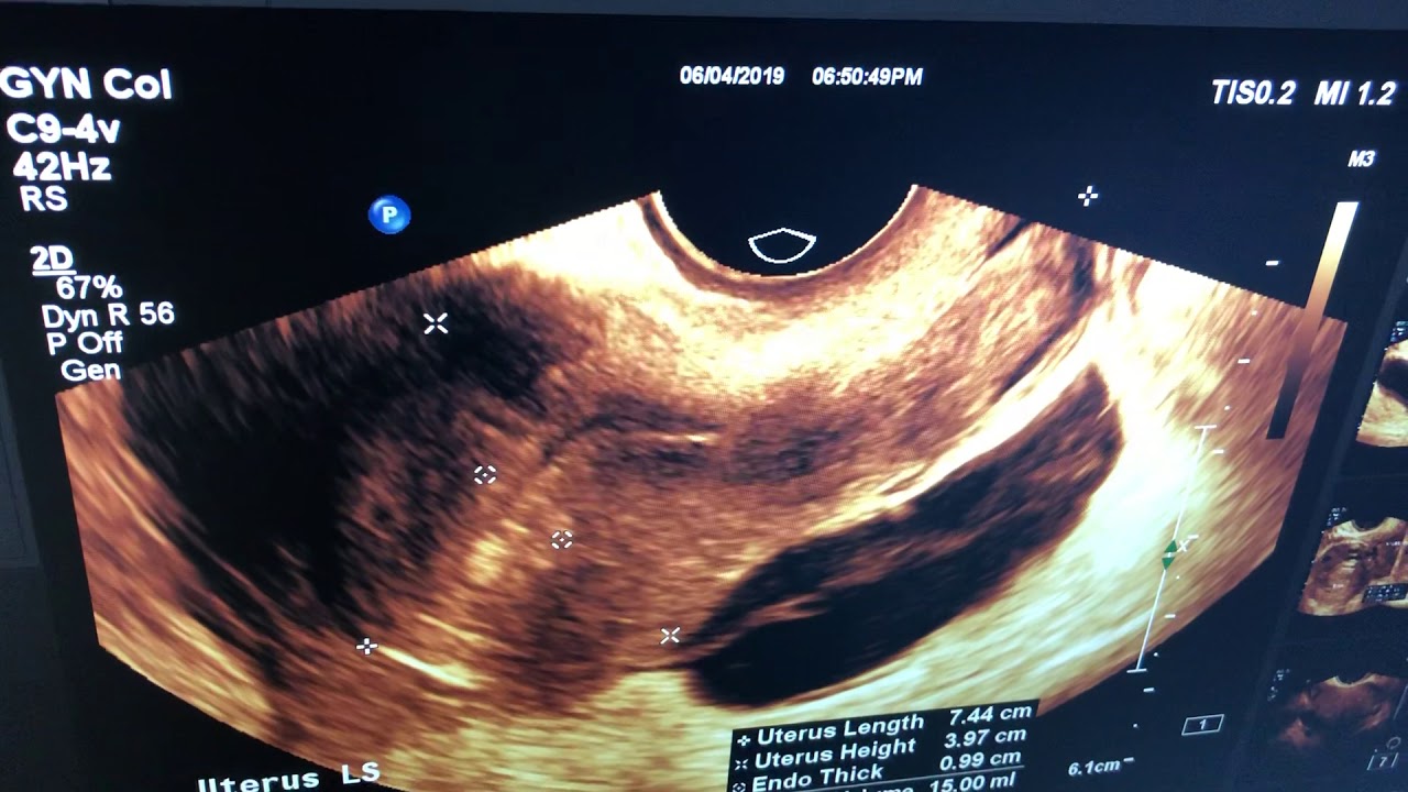 Trans Vaginal Ultrasound : Ruptured Ectopic Gestation or Perforation of ...
