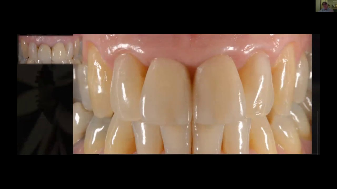 LIVE AID MASTERS OF DENTISTRY CAPITULO 12 'Ignazio Loi y Ricardo ...