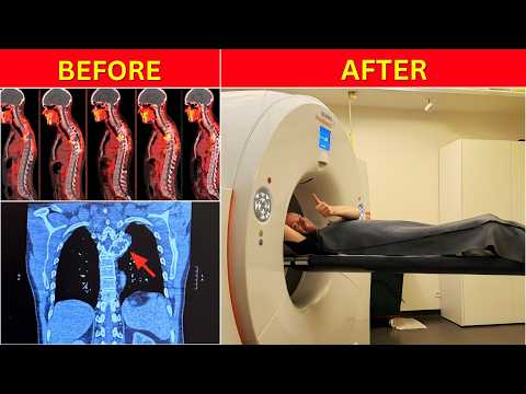 A CEO Finished His Morning Workout. 2 Weeks Later, His Spine Was Fused With Titanium.