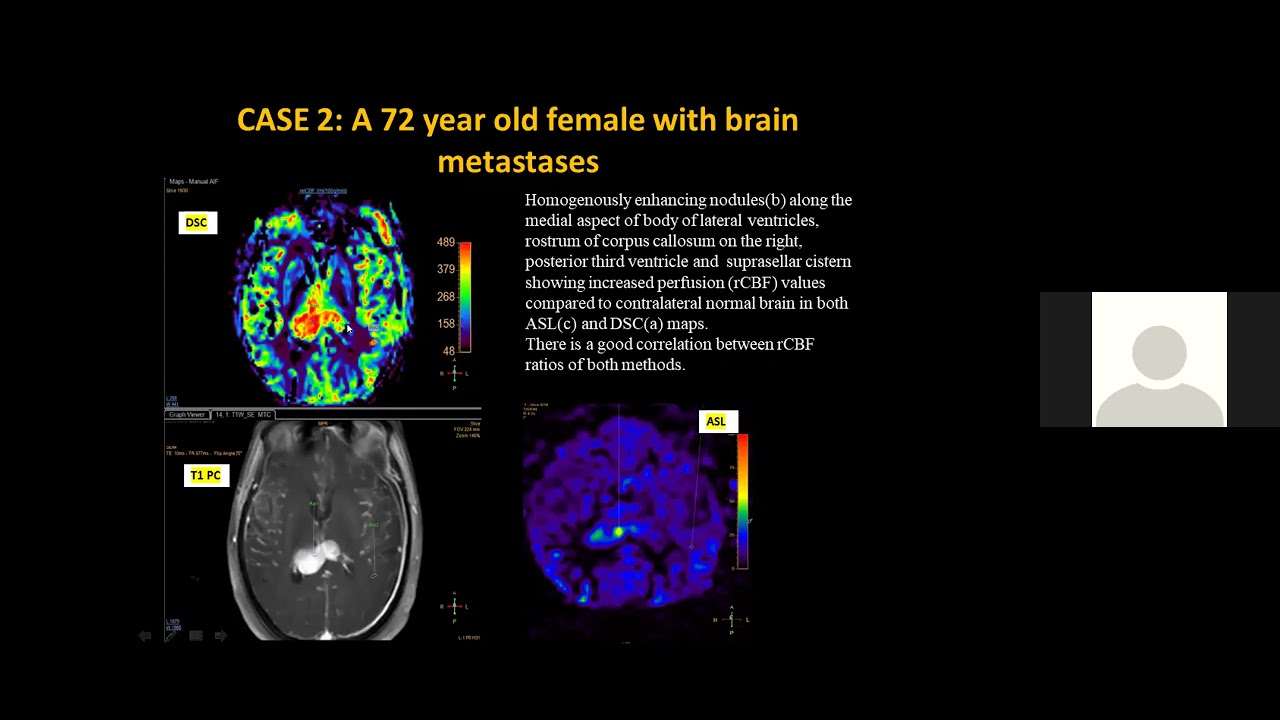 ASL MRI PERFUSION IMAGING IN BRAIN TUMORS and EMERGING CLINICAL ...