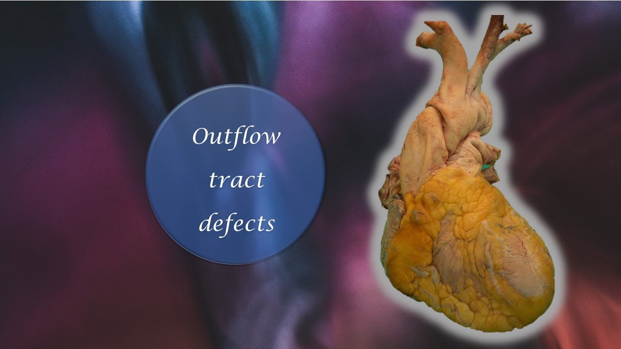 Embryology of the heart Part 8 Outflow tract defects - YouTube
