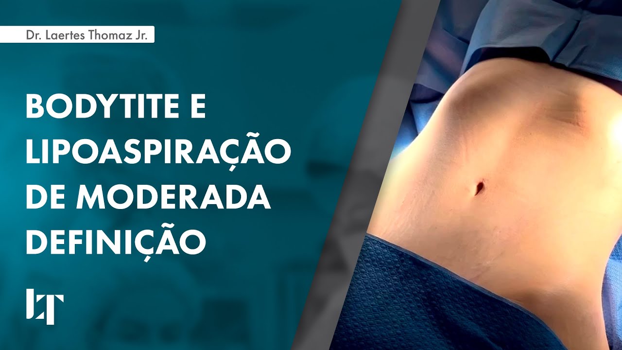BODYTITE E LIPOASPIRAÇÃO DE MODERADA DEFINIÇÃO | DR. LAERTES THOMAZ JR ...