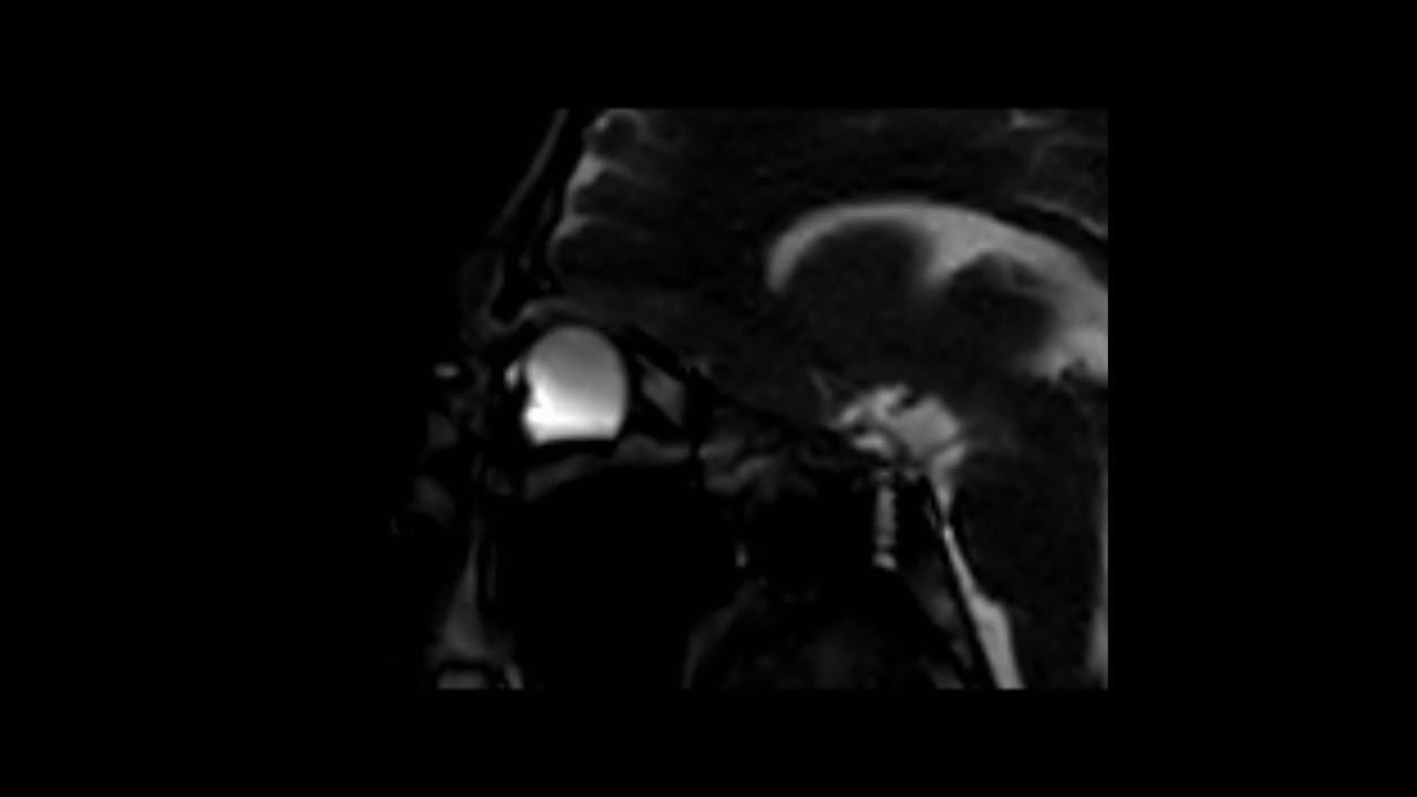 Imaged impact eye rubbing MRI - YouTube