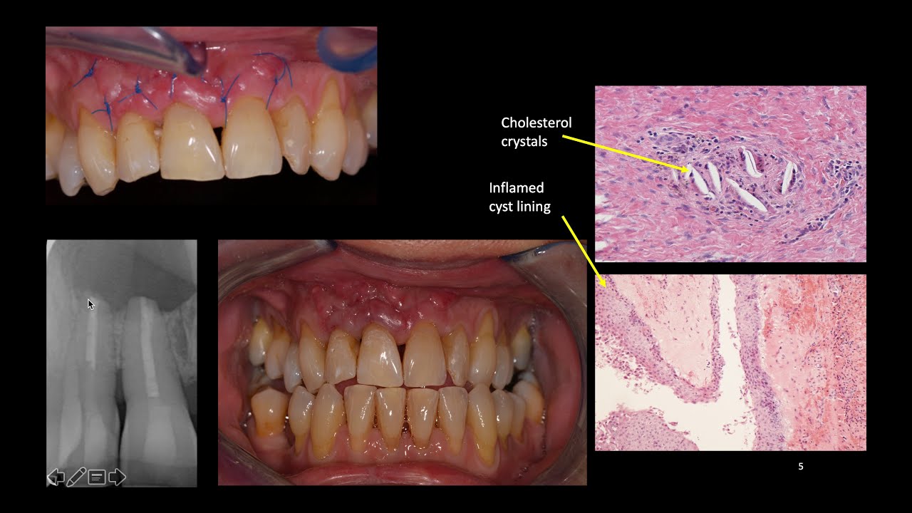 Surgical endodontics 1 - YouTube