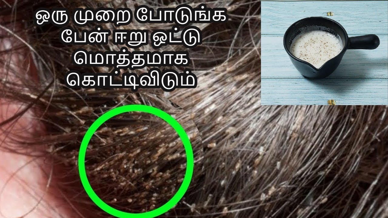  Lice