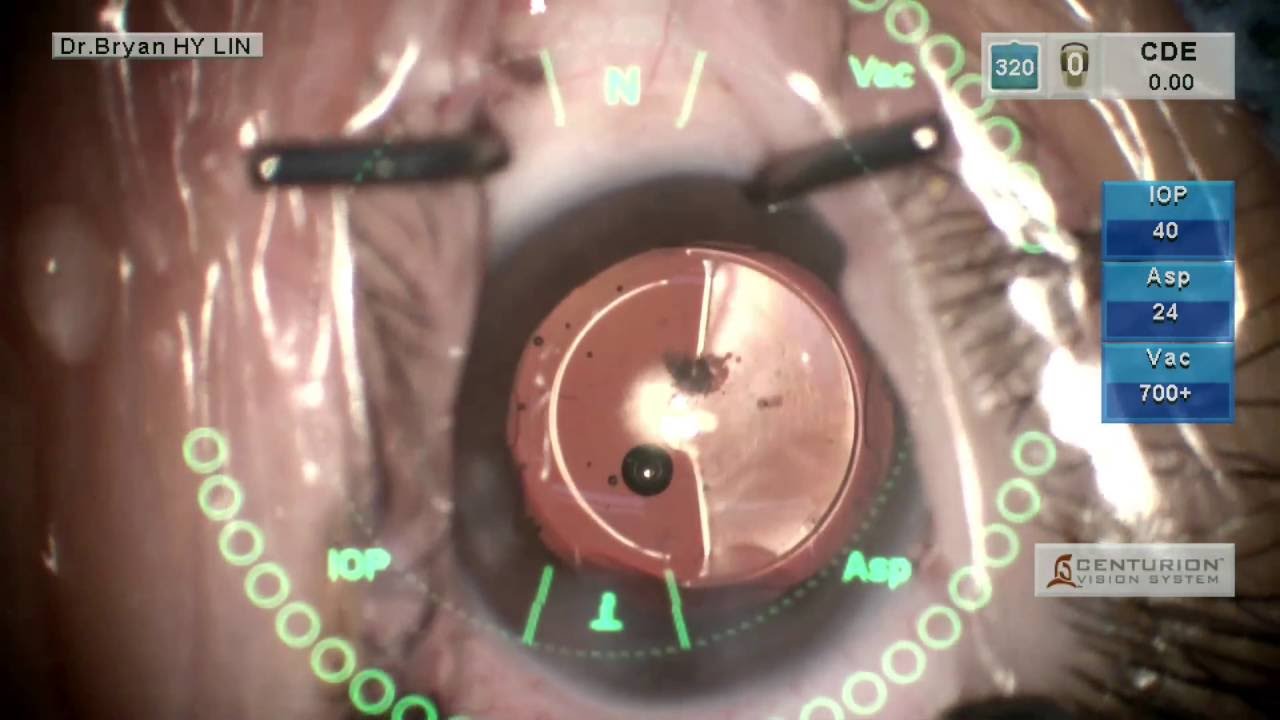 Lentis Mplus toric - YouTube