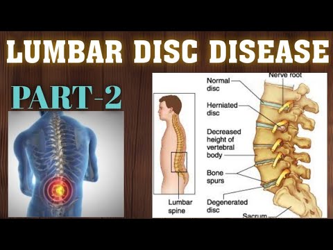 LUMBAR DISC DISEASE || PART-2 || CAUDA EQUINA SYNDROME || LUMBAR DICS ...