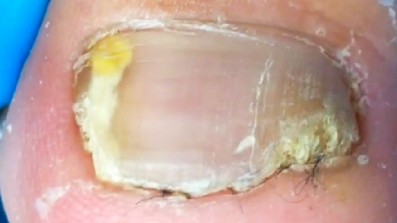 There Are Bad Nails On Both Sides Of The Toenails, Trim Them Thoroughly ...