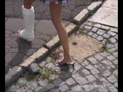 SLWC - Beautiful casted leg - YouTube