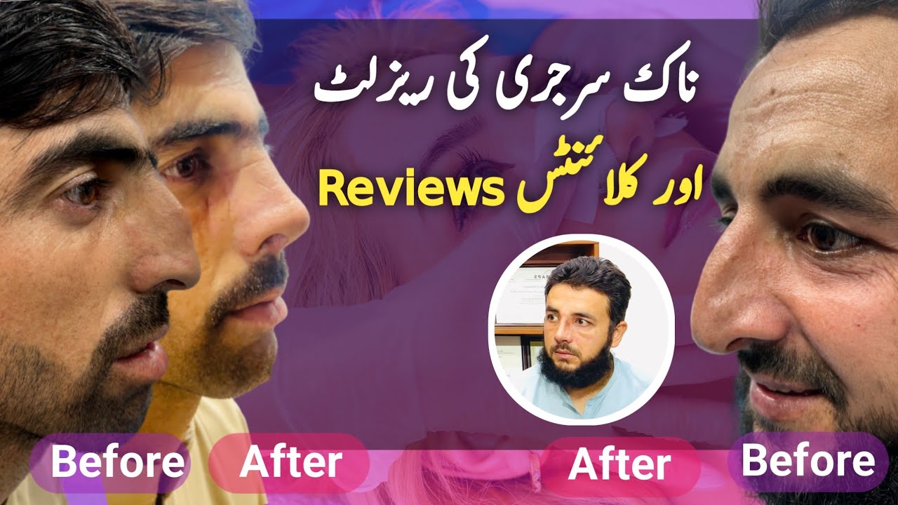 Rhinoplasty Before and After: Honest Reviews from 2 Clients | Dr. Habib ...