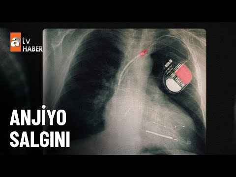 Gereksiz anjiyoda ölüm riski - atv Haber 6 Haziran 2025