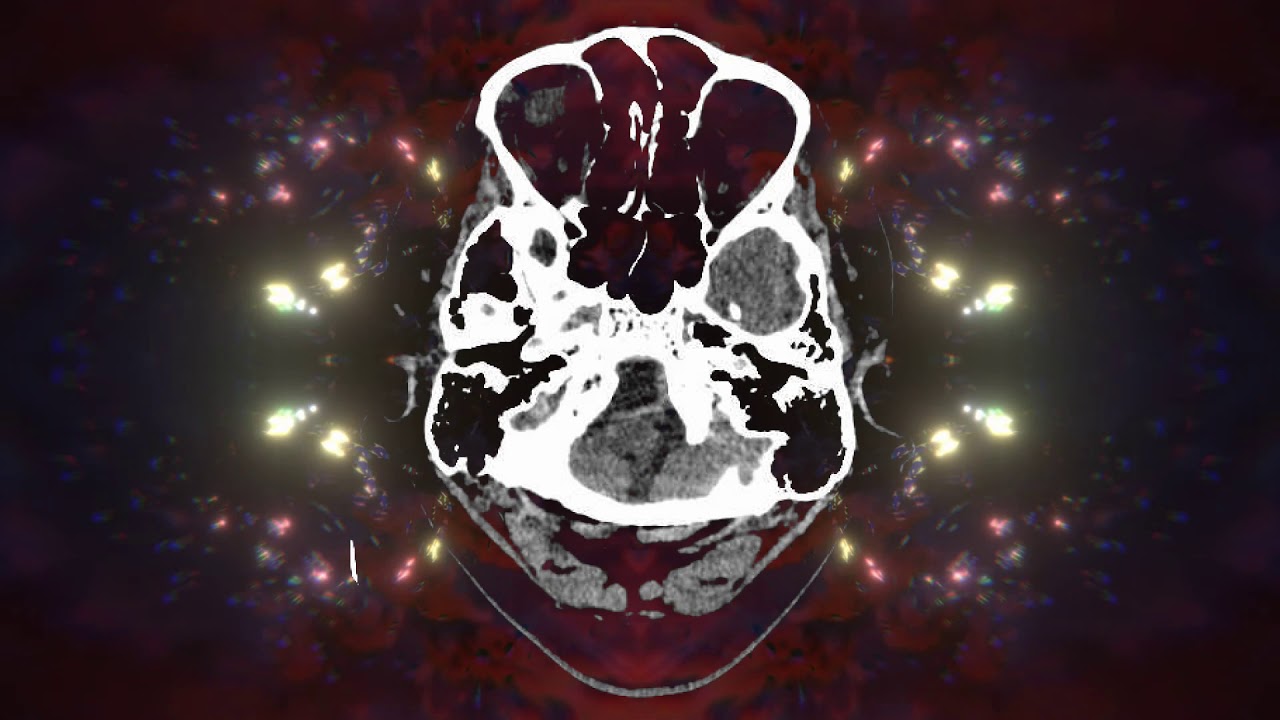 Oude CT-scan van mijn schedel - YouTube