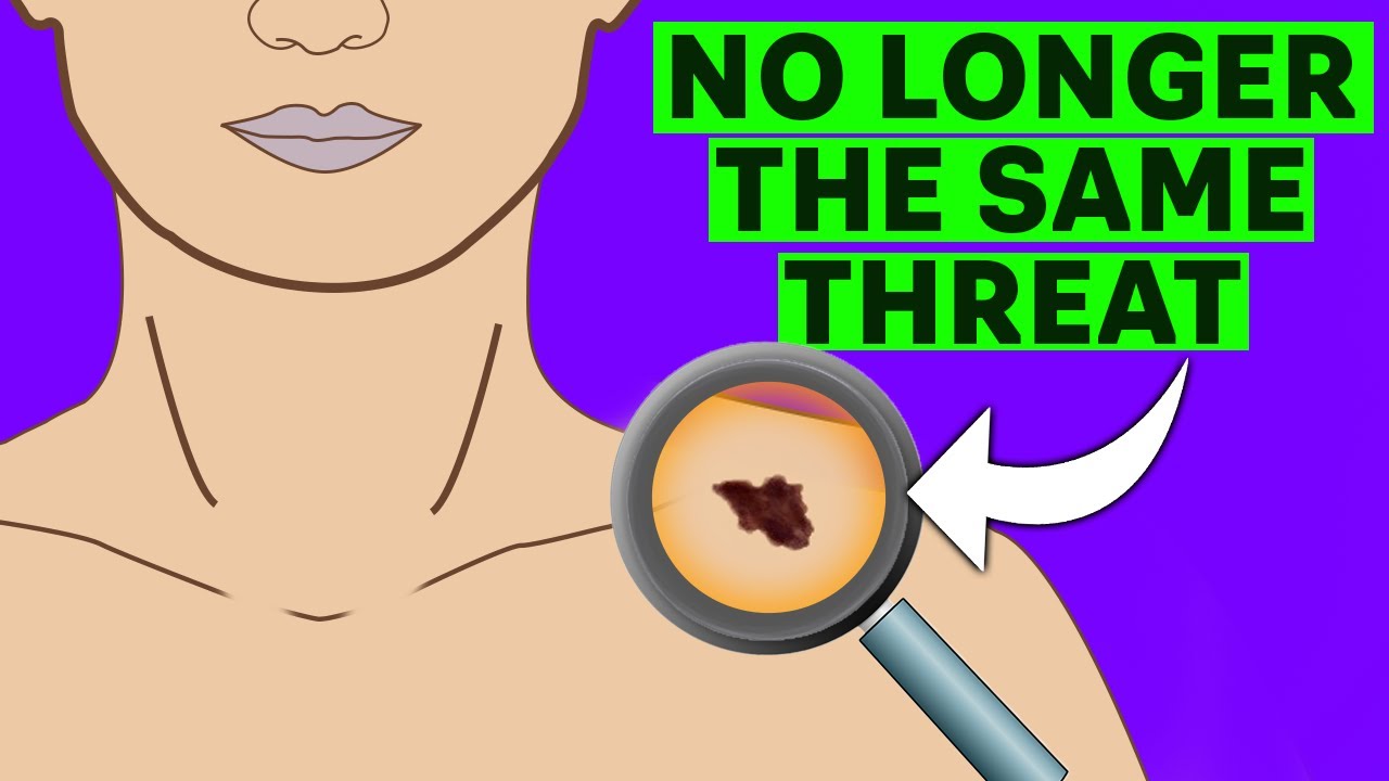 Melanoma is Becoming Easier to Treat | TARGET: Cancer Podcast | Ep. #13 ...