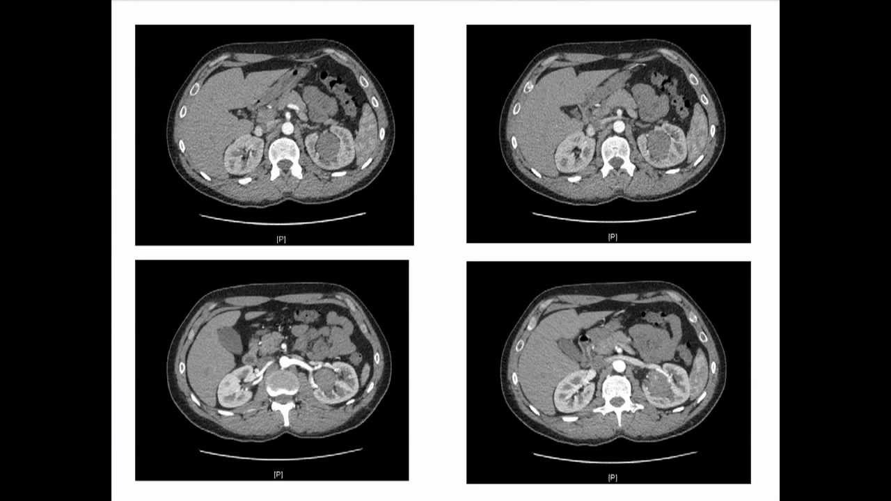 Stage 1b RCC: Partial Nephrectomy the New Standard-CON Didier Jacqmin ...