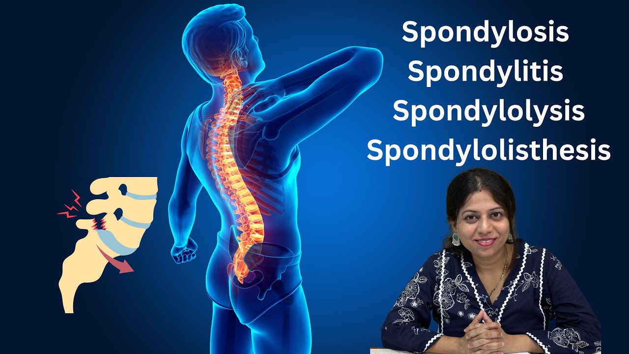 Spondylosis vs Spondylitis vs Spondylolysis vs Spondylolisthesis ...