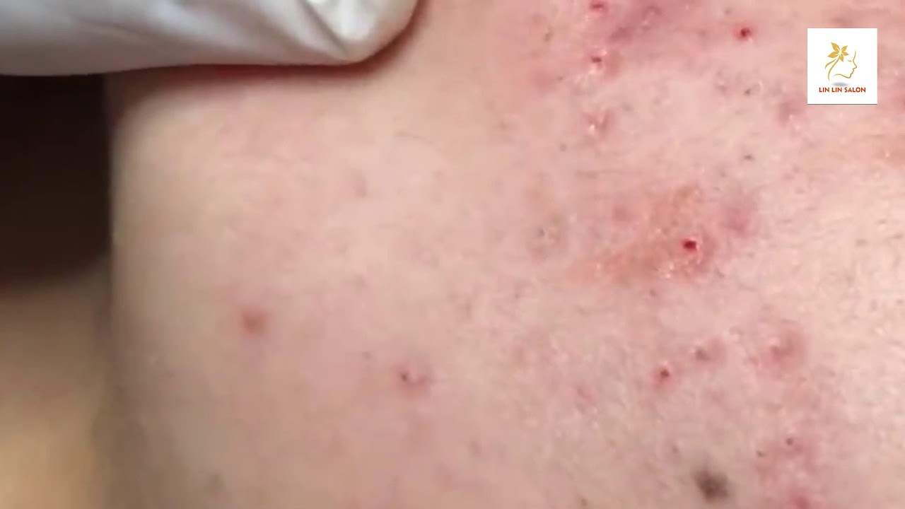 Blackheads Hidden Deep Under The Skin How To Remove Blackhead 15 12