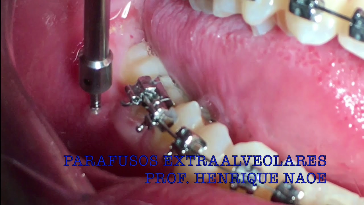 BUCCAL SHELF COM - YouTube