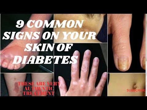 9 common diabetes signs on the skin | Diabetes | Diabetes symptoms ...