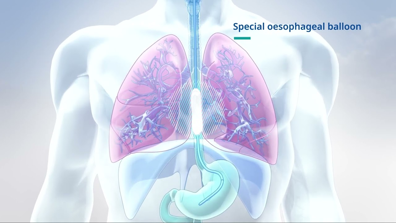 PesoCath – the key for oesophageal and transpulmonary pressure ...