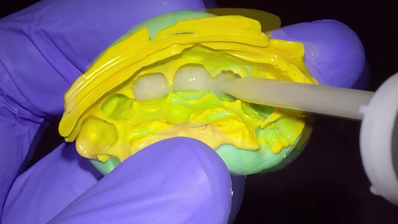 Infected Tooth Removal and Bridge Replacement - YouTube