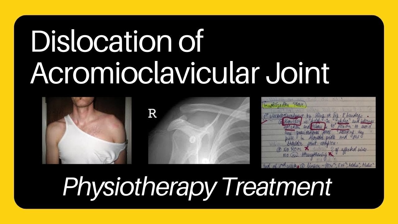 Dislocation of Acromioclavicular Joint & its Physiotherapy Treatment ...