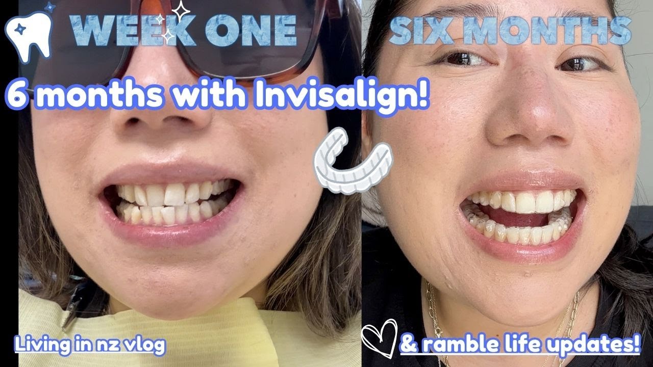 6 month Invisalign adult braces update 🦷 Goals for 2025, life updates ...