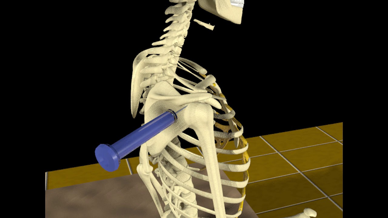 Subacromial Shoulder Injection - YouTube