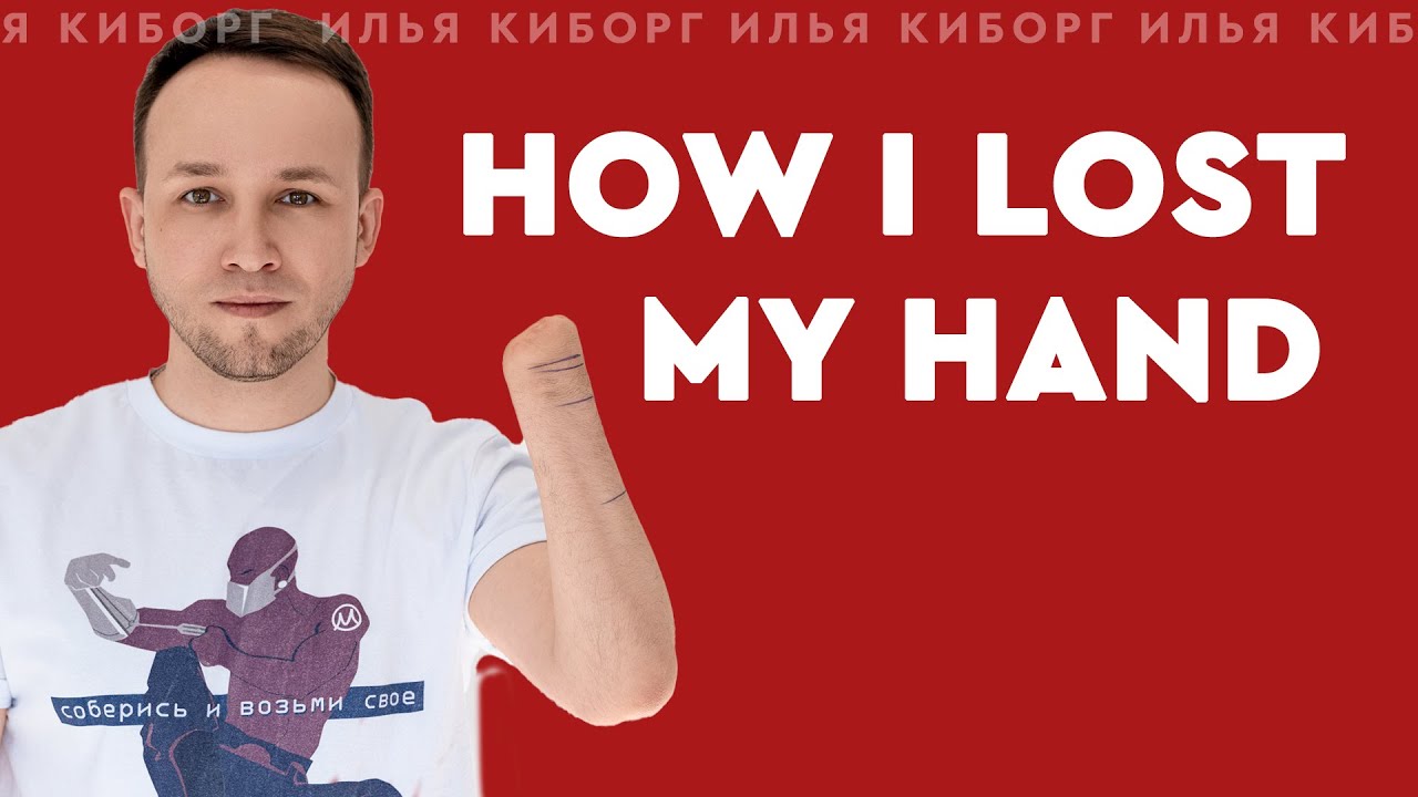 How I lost my Arm and what it's like to Live with One Arm - YouTube