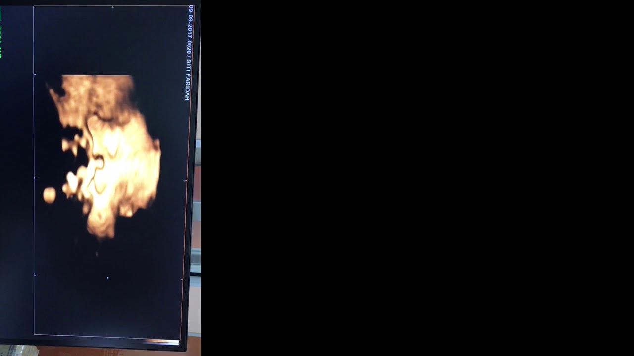 Scan baby 6D - YouTube