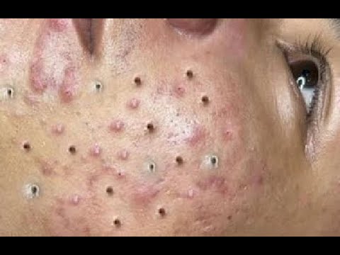 Satisfying And Relaxation with NaSa Beauty Spa #16 black point and acne ...