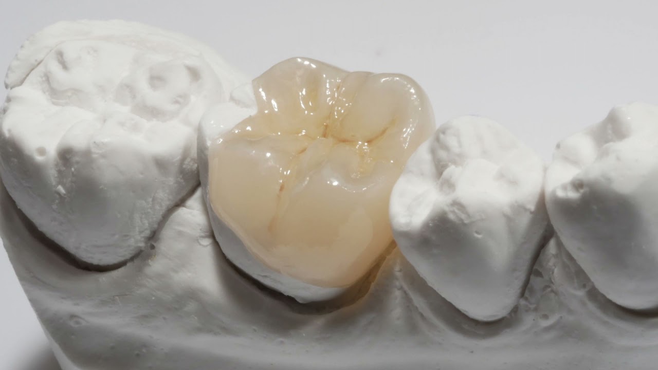 Ceramic Onlay/ Overlay / 46 bonded indirect restoration (GC Lisi Press ...