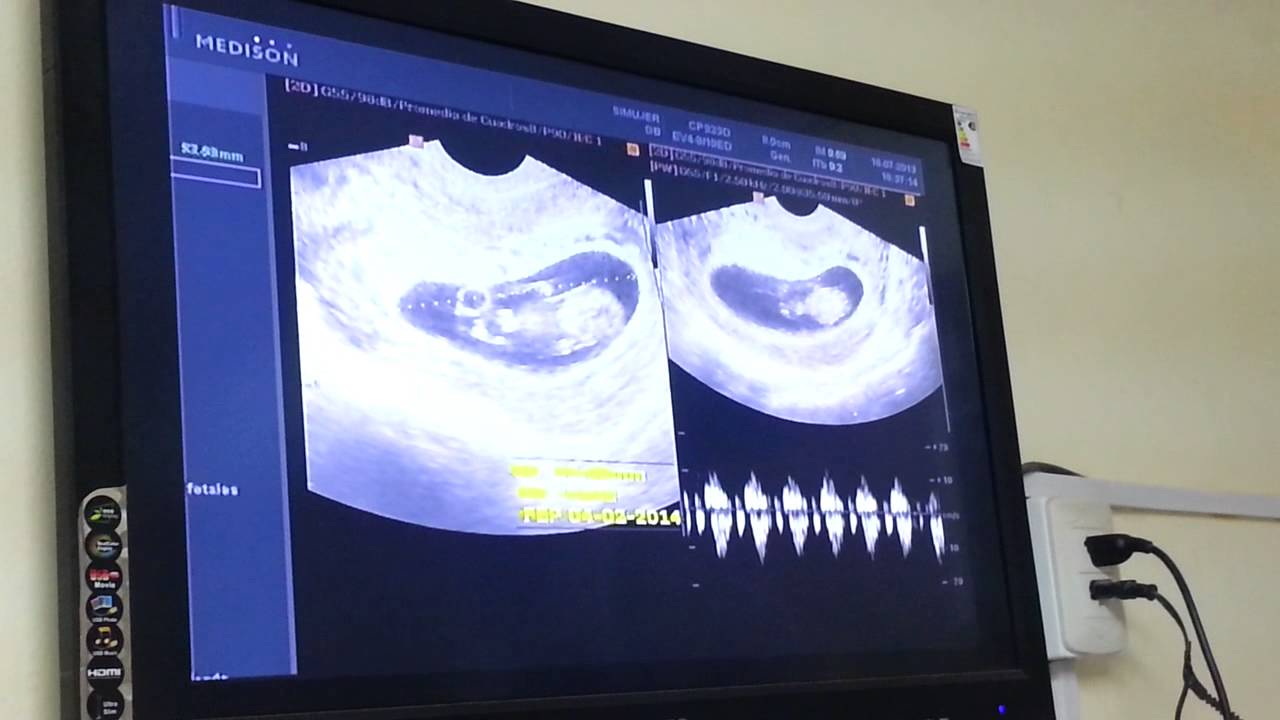 Ecografia de 10 semanas de embarazo - YouTube
