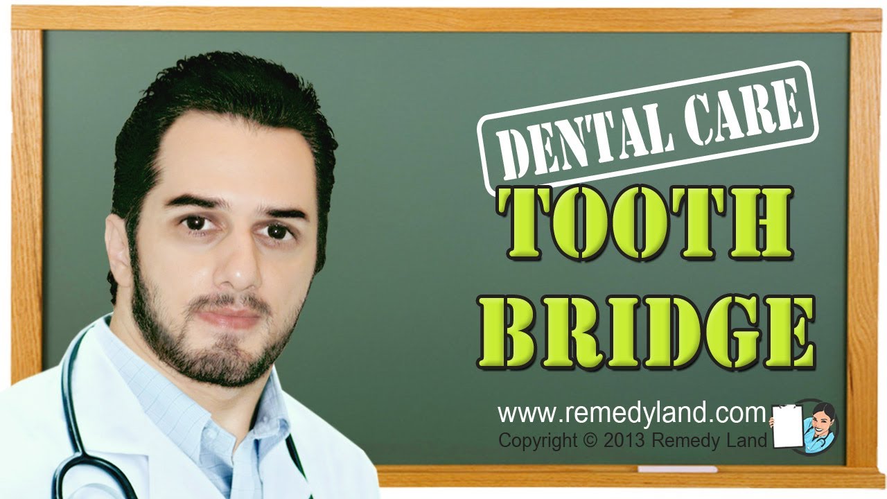 Tooth bridge or dental bridge - Fixed, Maryland, Cantilever, Nesbit ...