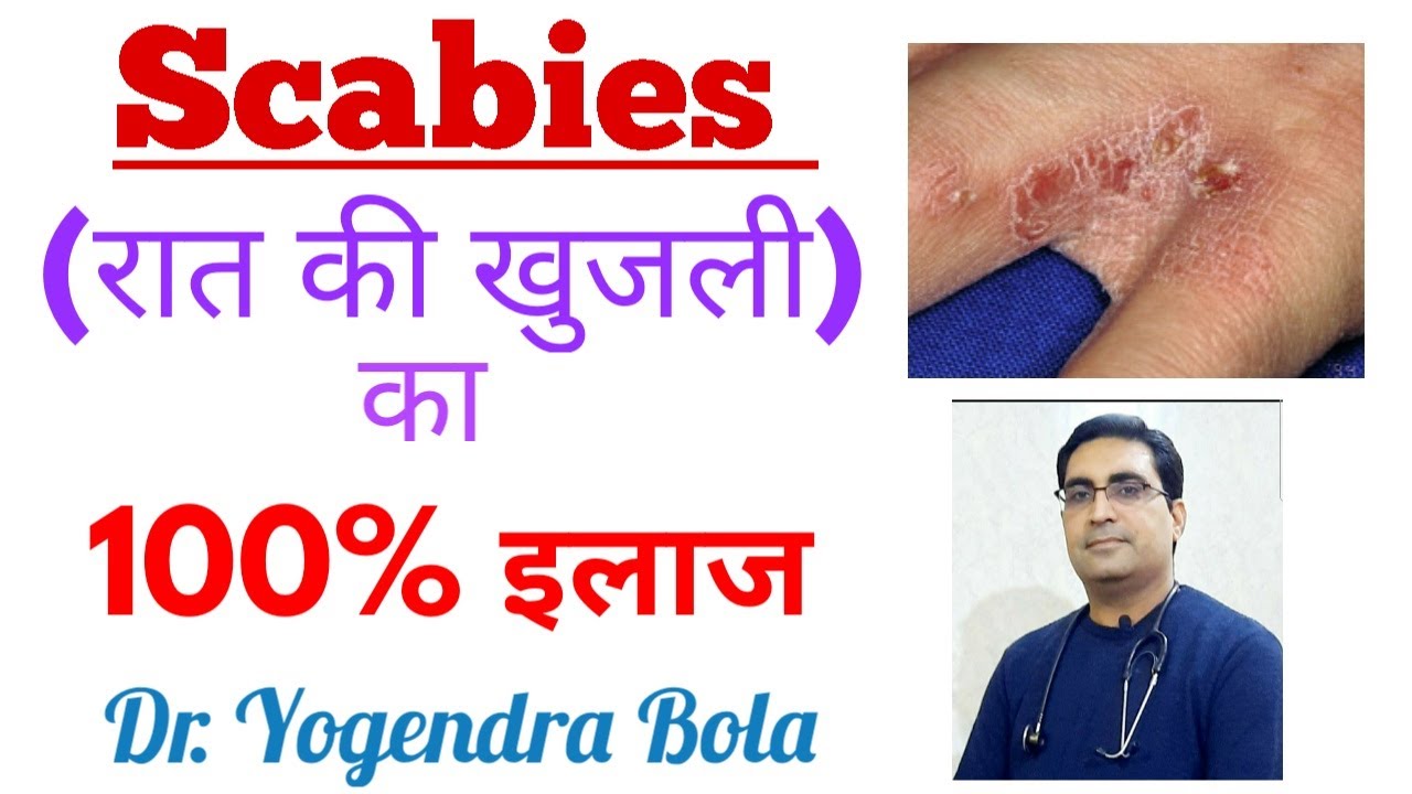 Scabies - ka complete treatment in hindi | scarab ,scabilice lotion ...