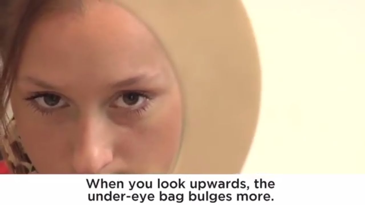 Laser eye bags removal by Doctor Bernard Hayot - YouTube